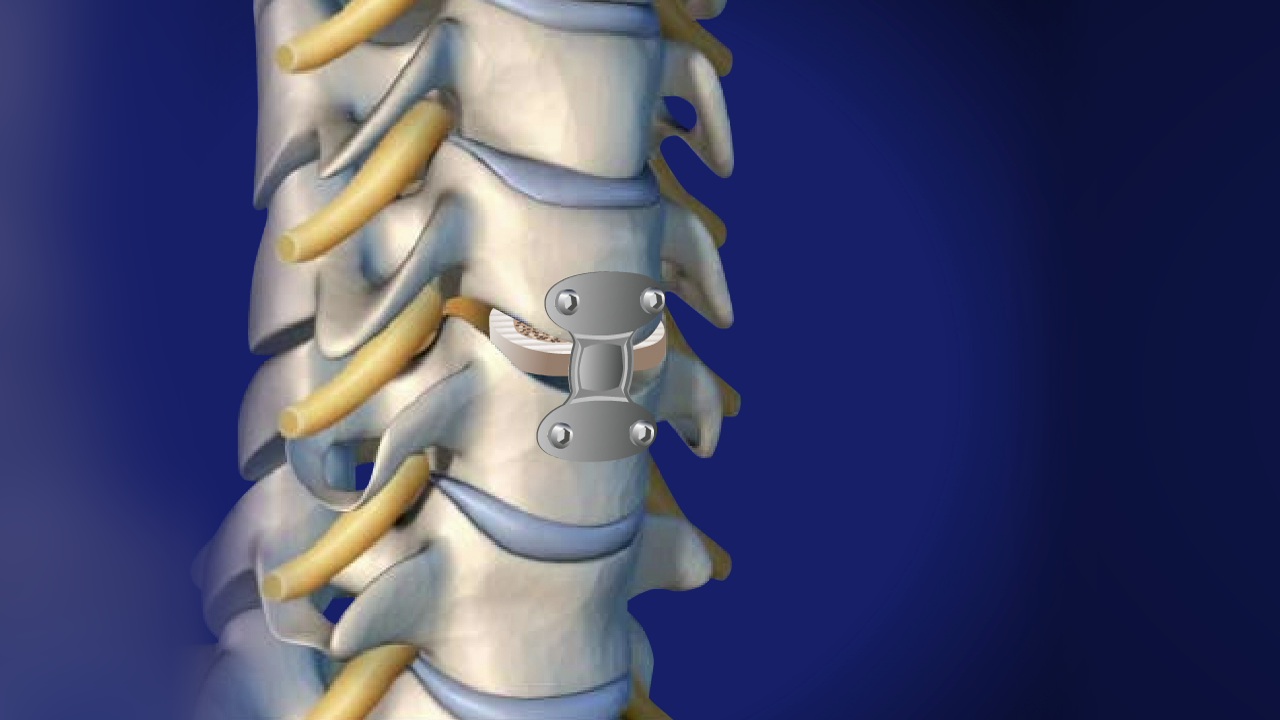 Watch: Anterior Cervical Discectomy and Fusion (Intervertebral Spacer)