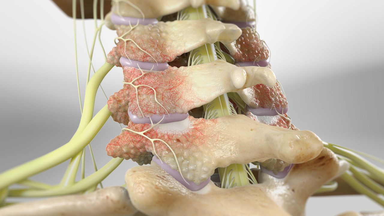 Watch: Cervical Facet Joint Syndrome