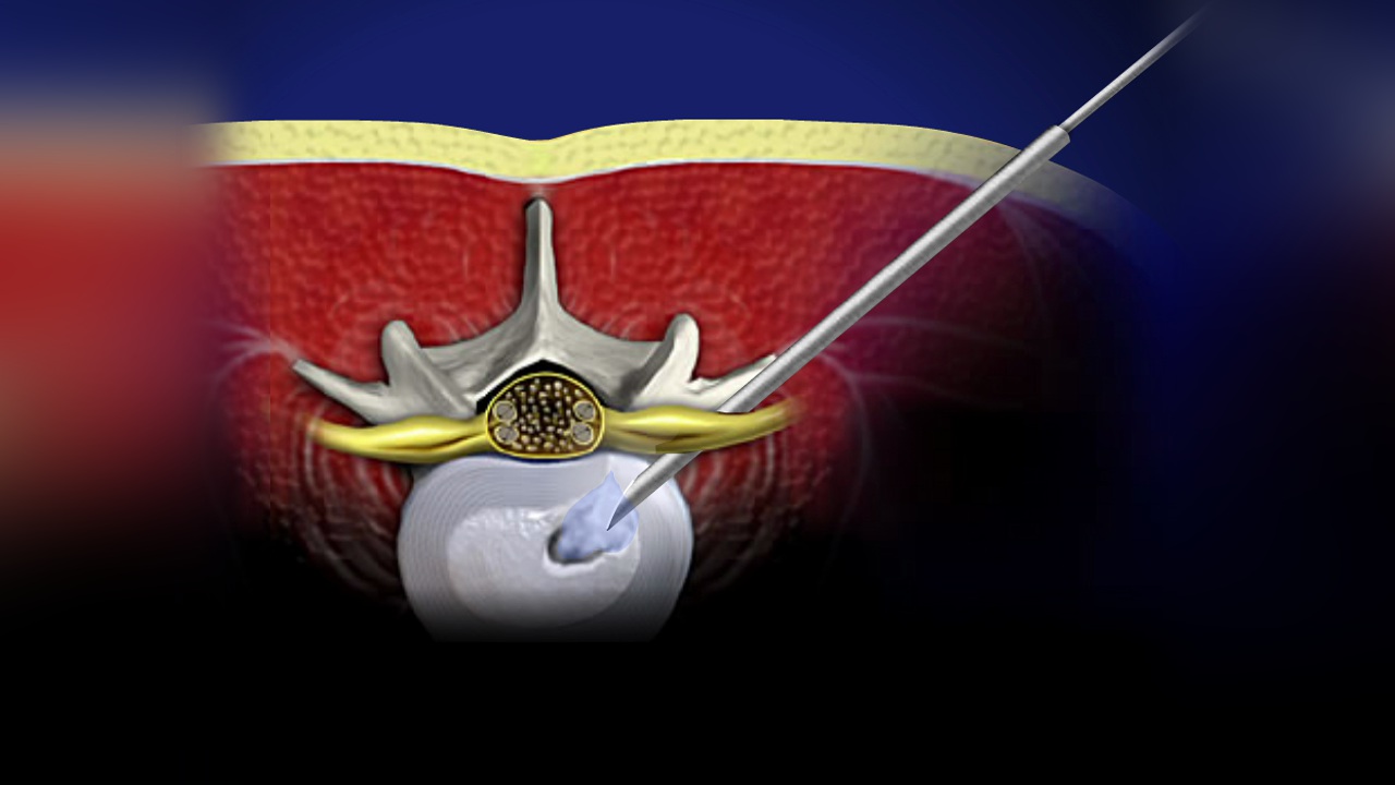 Watch: Lumbar Discoscopic Discectomy