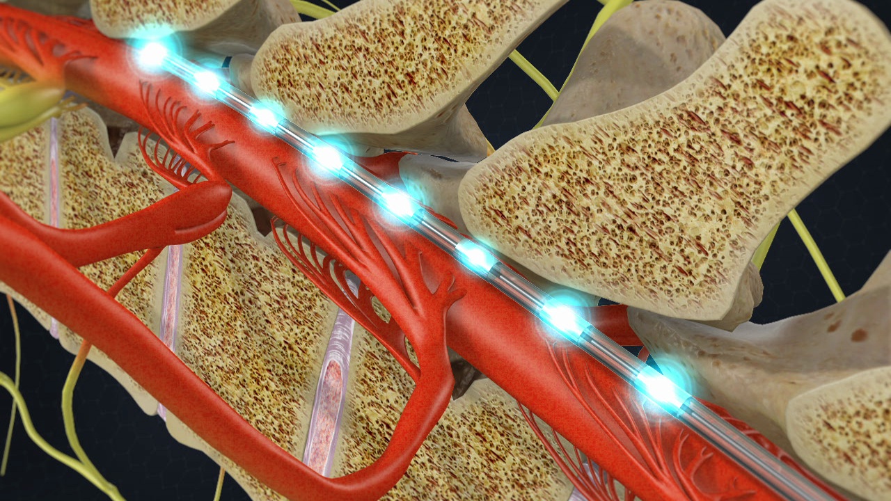 Watch: Spinal Cord Stimulation (Paddle Lead, Medtronic)