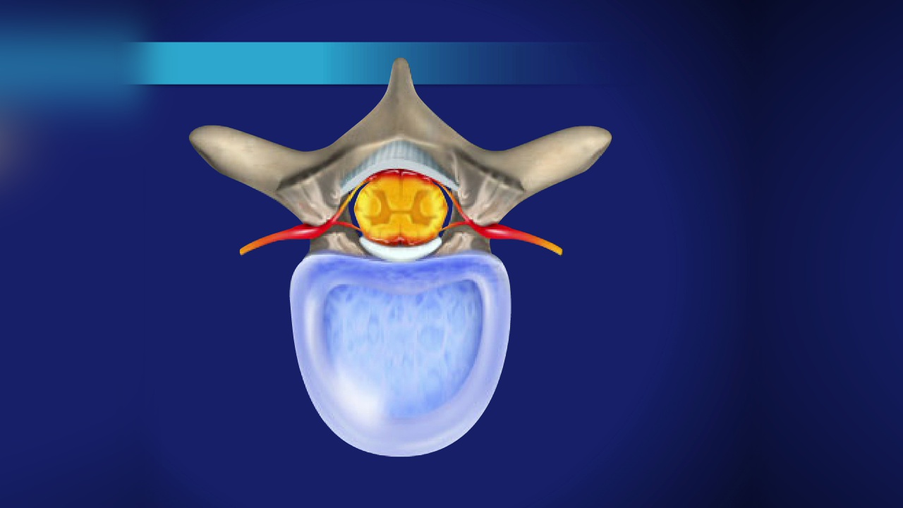 Watch: Spinal Stenosis (Thoracic)